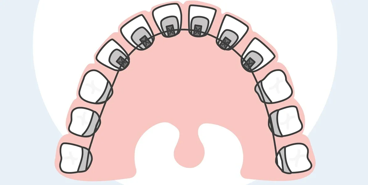 lingual braces deep overbite